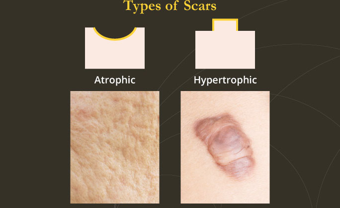All You Need To Know About Scar Removal Treatments - Beauty Machine ...